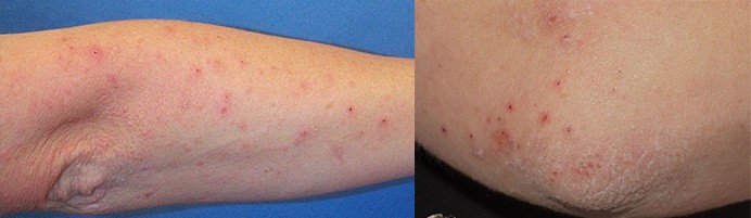 Pregnancy Rash Treatment Dr Joycelim Dermatologist Skin Specialist Pregnancy Rash Treatment Dr Joycelim Dermatologist Skin Specialist